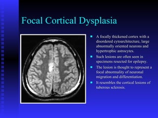 Congenital malformation of cns | PPT