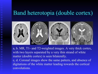 Congenital malformation of cns | PPT