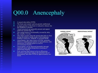 Congenital malformation of cns | PPT