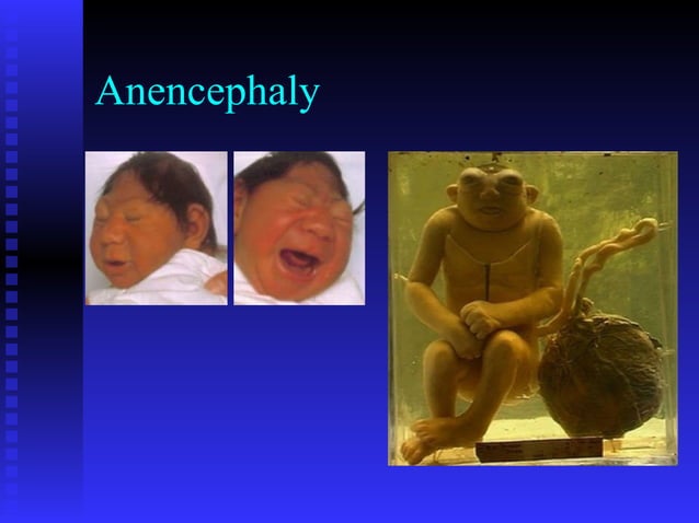Congenital malformation of cns | PPT