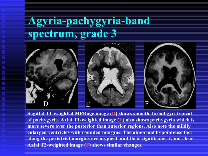 Congenital malformation of cns