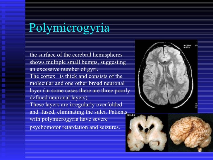 Congenital malformation of cns