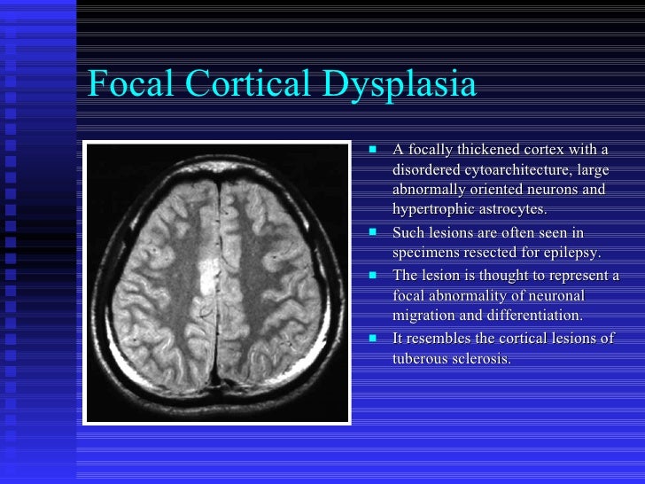 Congenital malformation of cns