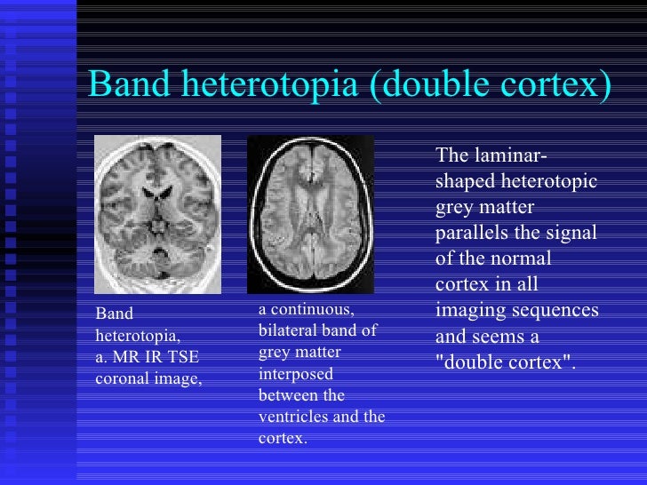 Congenital malformation of cns