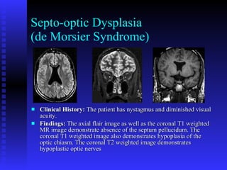 Congenital malformation of cns encephalocele | PPT