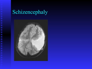 Congenital malformation of cns encephalocele | PPT