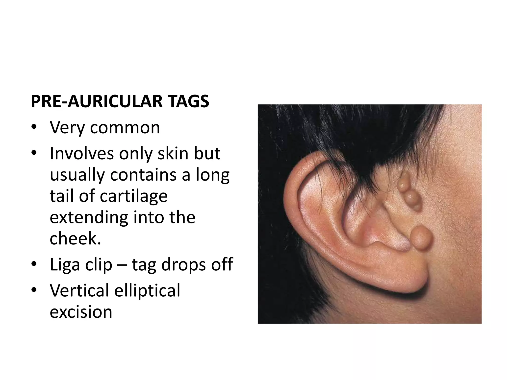 Congenital malformation of external ear and it’s management | PPTX