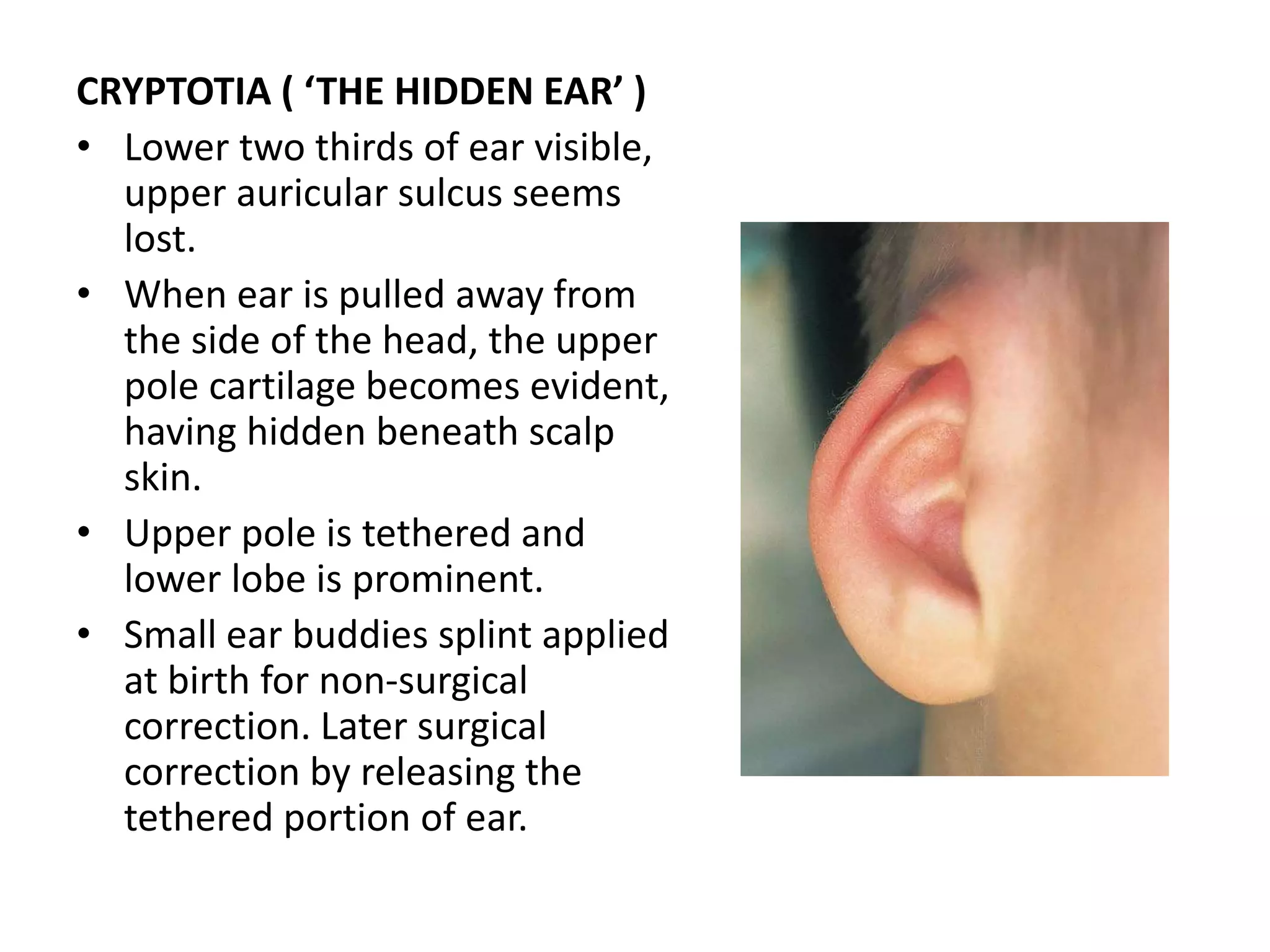 Congenital malformation of external ear and it’s management | PPTX
