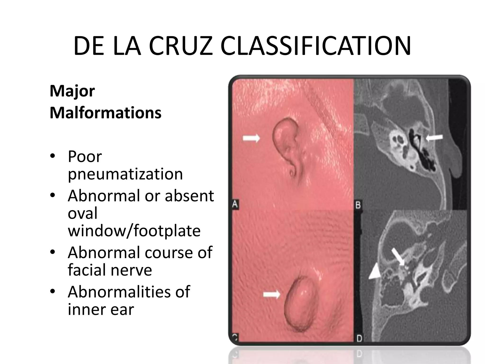 Congenital malformation of external ear and it’s management | PPTX