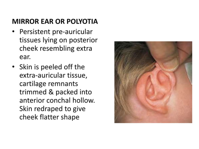 Congenital malformation of external ear and it’s management | PPTX ...
