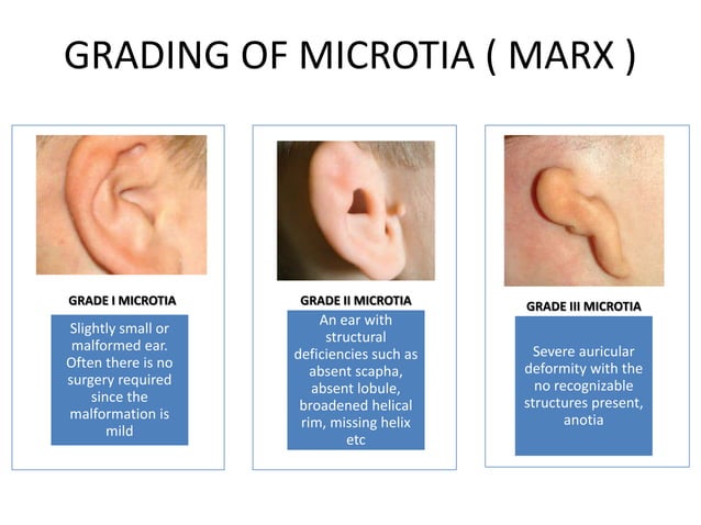 Congenital malformation of external ear and it’s management | PPTX ...