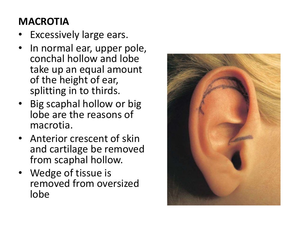 Congenital malformation of external ear and it’s management