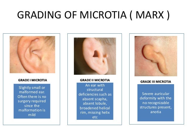 Congenital malformation of external ear and it’s management