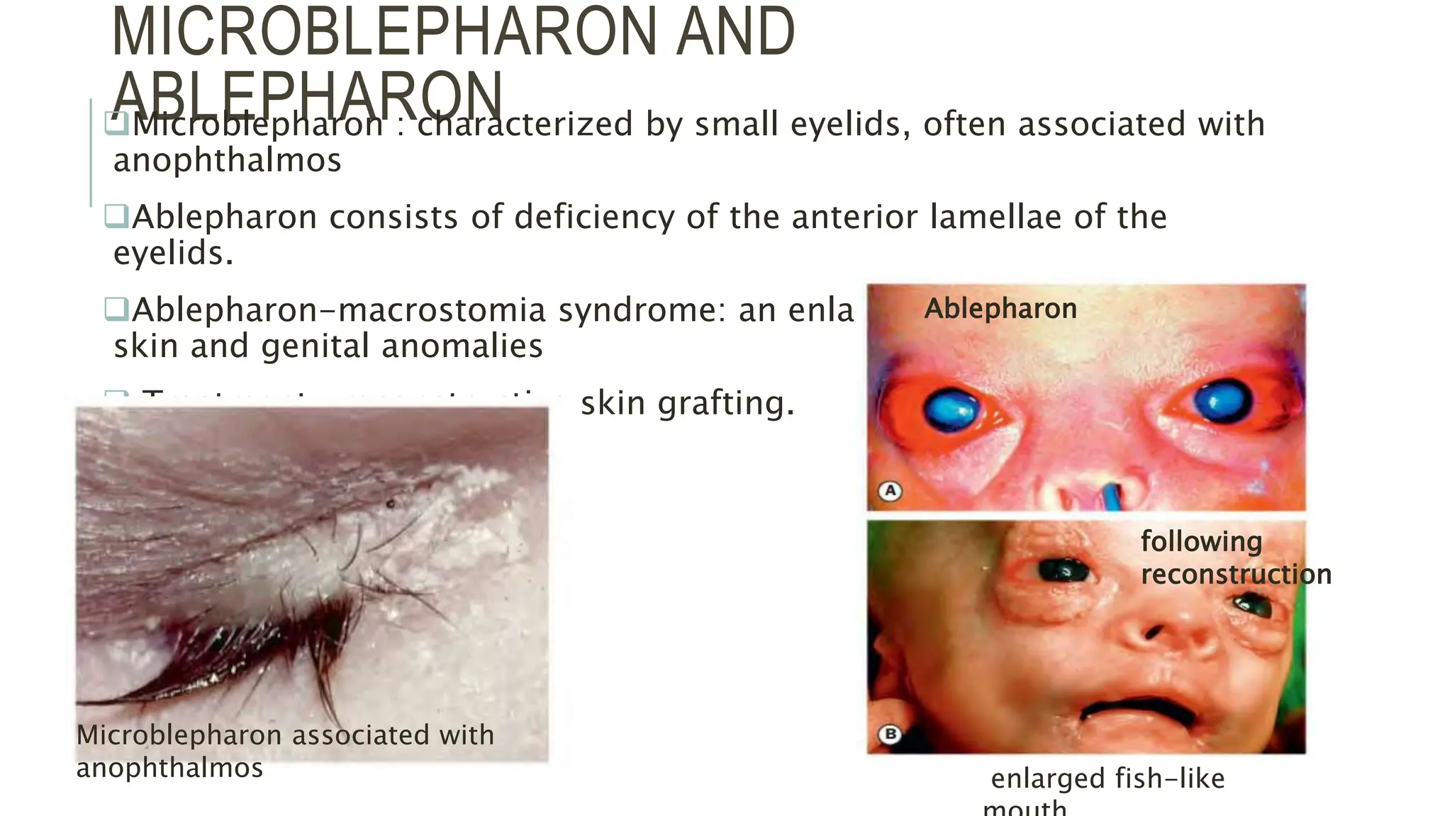 CONGENITAL MALFORMATIONS OF EYELIDS.pptx