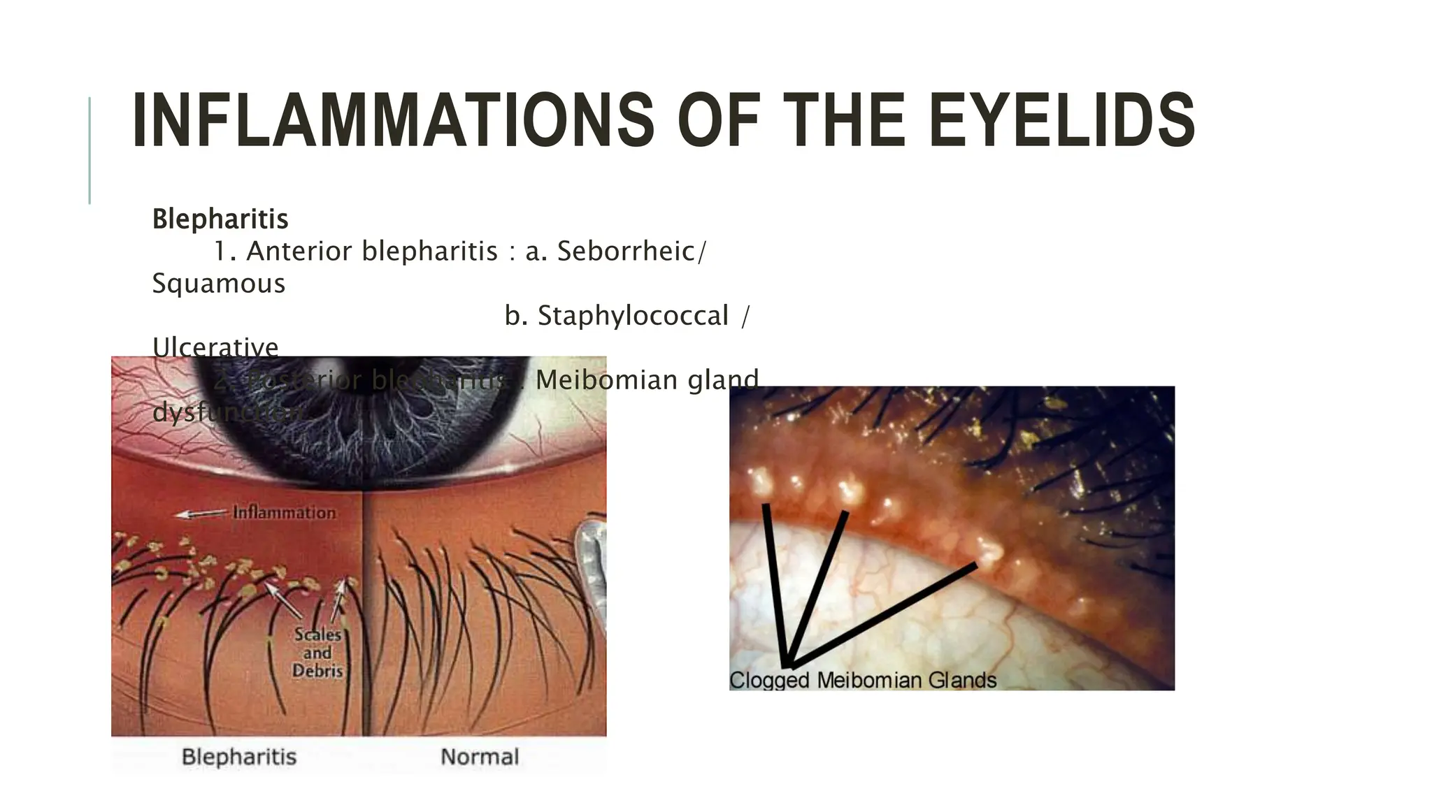 CONGENITAL MALFORMATIONS OF EYELIDS.pptx