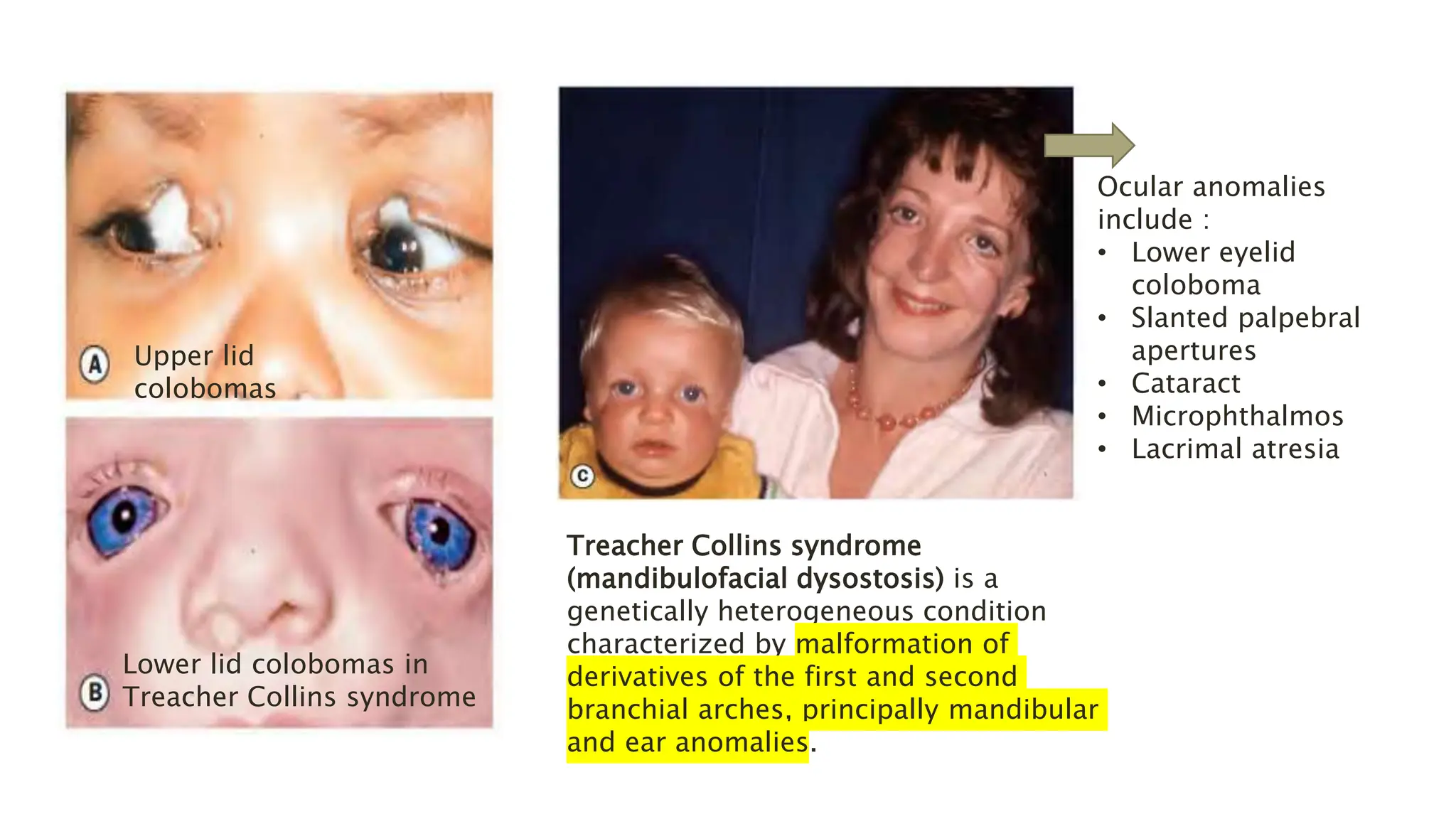 CONGENITAL MALFORMATIONS OF EYELIDS.pptx