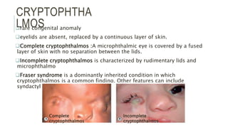 CONGENITAL MALFORMATIONS OF EYELIDS.pptx | Ear, Nose and Throat ...