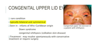 CONGENITAL MALFORMATIONS OF EYELIDS.pptx | Ear, Nose and Throat ...