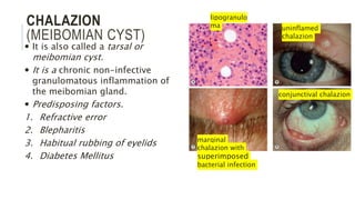 CONGENITAL MALFORMATIONS OF EYELIDS.pptx