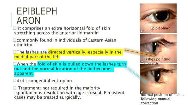 CONGENITAL MALFORMATIONS OF EYELIDS.pptx | Ear, Nose and Throat ...