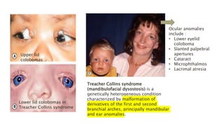 CONGENITAL MALFORMATIONS OF EYELIDS.pptx | Ear, Nose and Throat ...