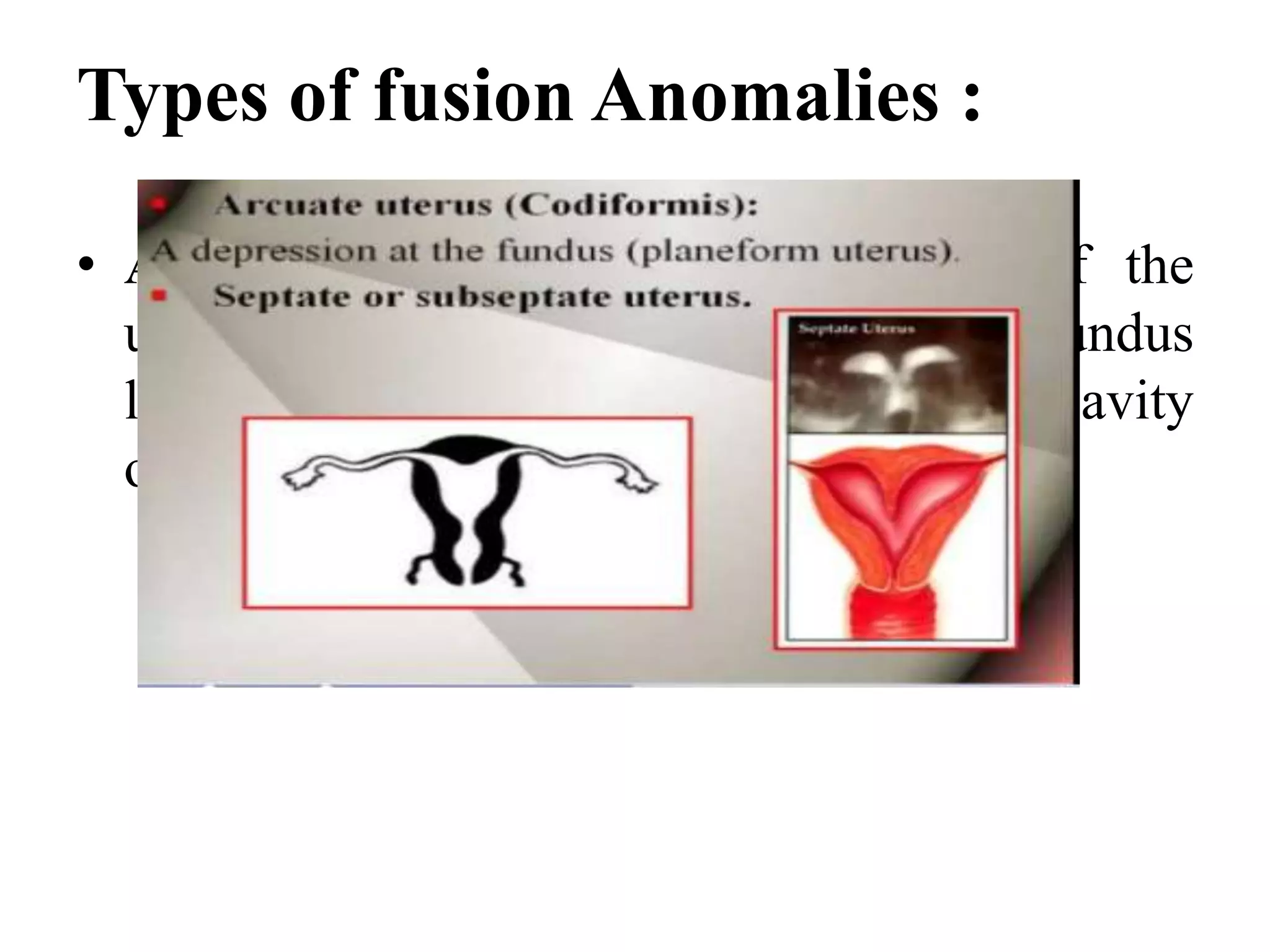 Congenital malformation of female reproductive organ | PPTX