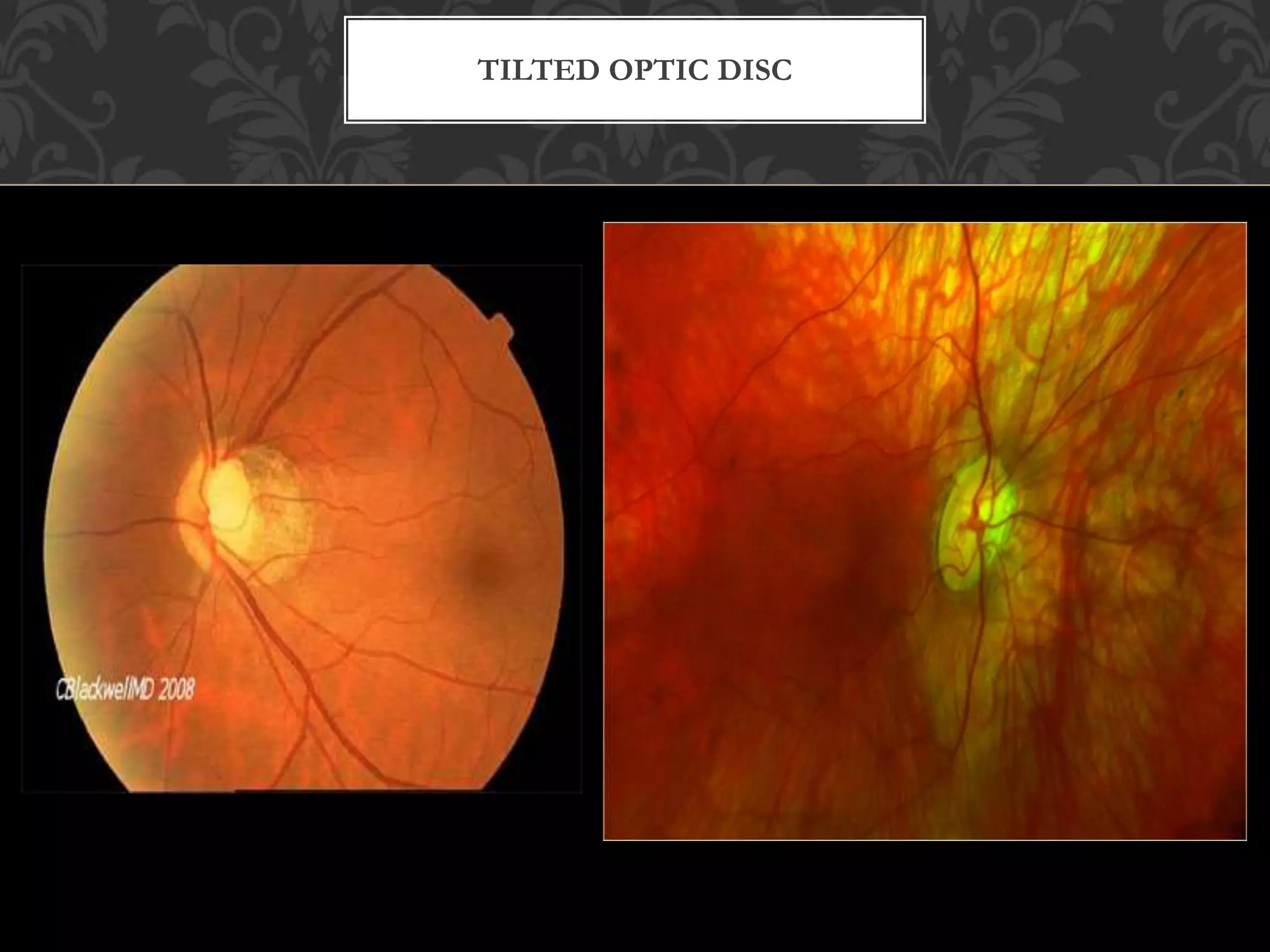Congenital malformation of optic nerve and choroid | PPTX | Eye and Vision Conditions | Diseases ...