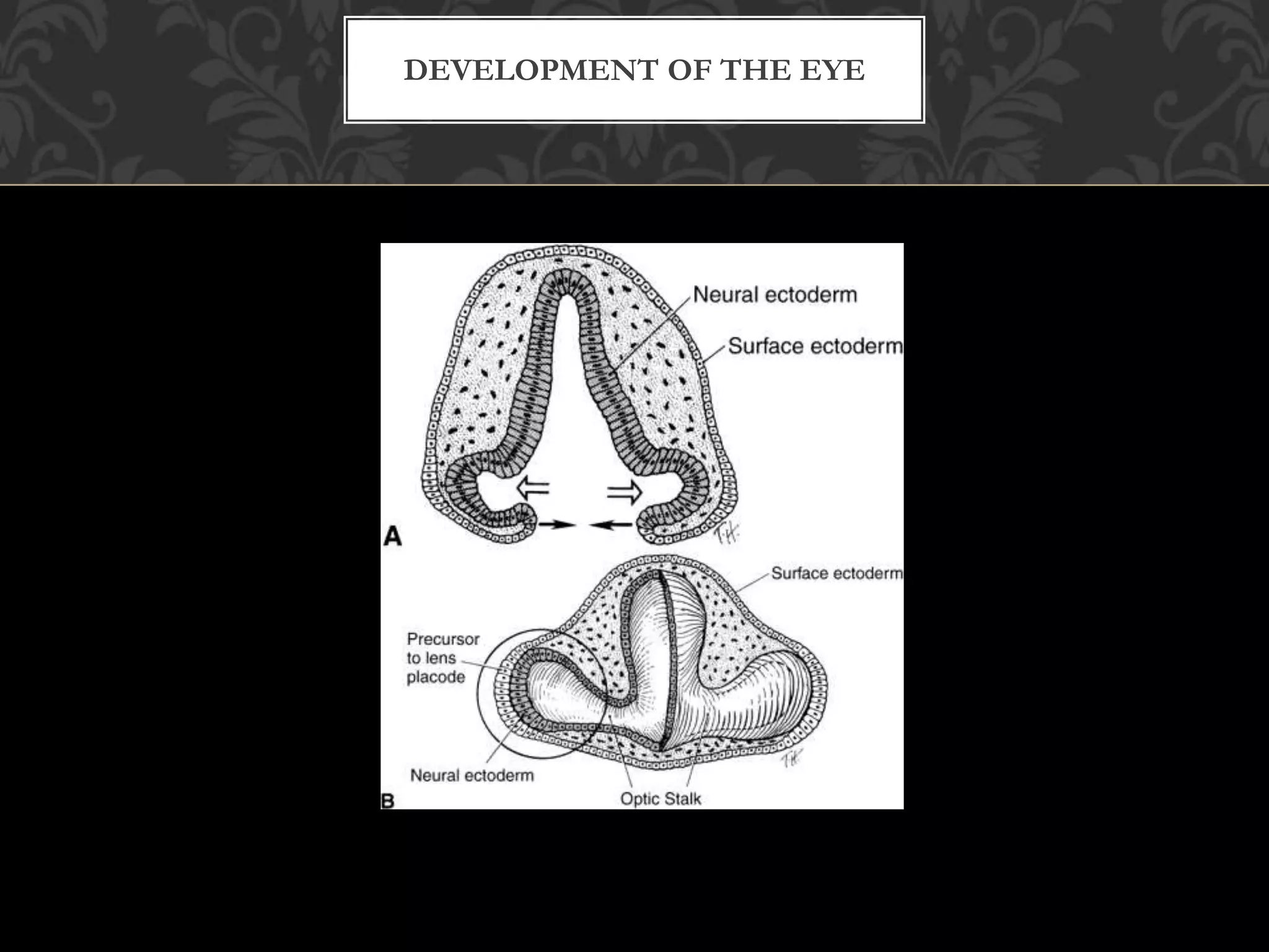 Congenital malformation of optic nerve and choroid | PPTX | Eye and Vision Conditions | Diseases ...