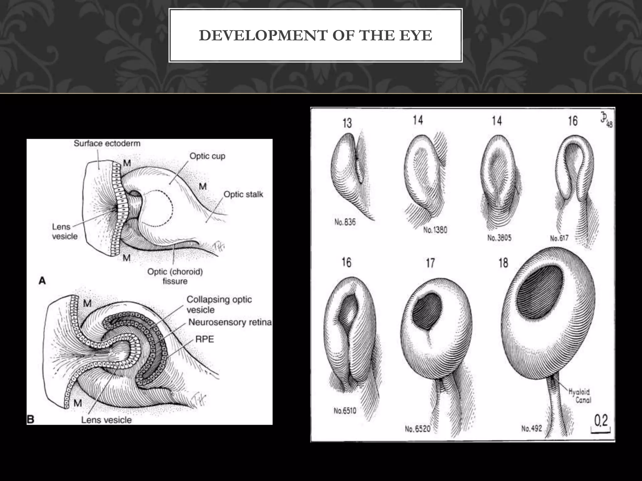 Congenital malformation of optic nerve and choroid | PPTX | Eye and Vision Conditions | Diseases ...
