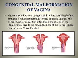 Congenital Malformation Of Uterus And Vagina 2pptx