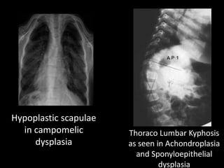 Congenital Malformations of Bone | PPTX