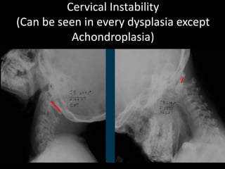 Congenital Malformations of Bone | PPTX