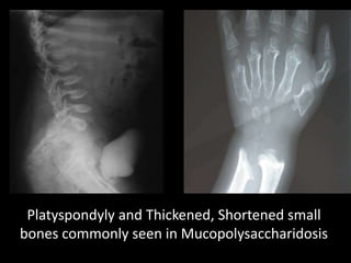 Congenital Malformations of Bone | PPTX