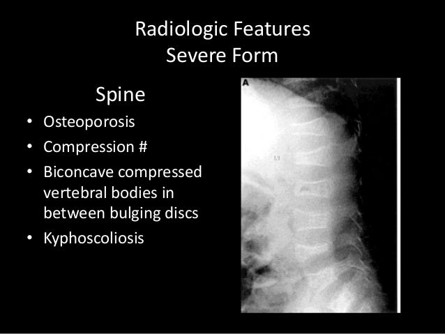 Congenital Malformations of Bone