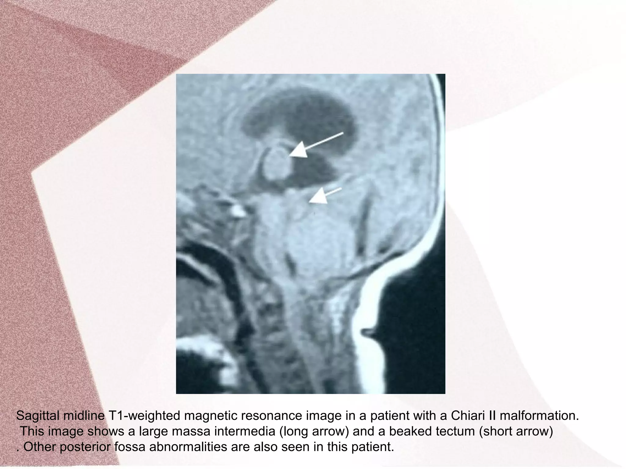Congenital malformations of brain | PPT