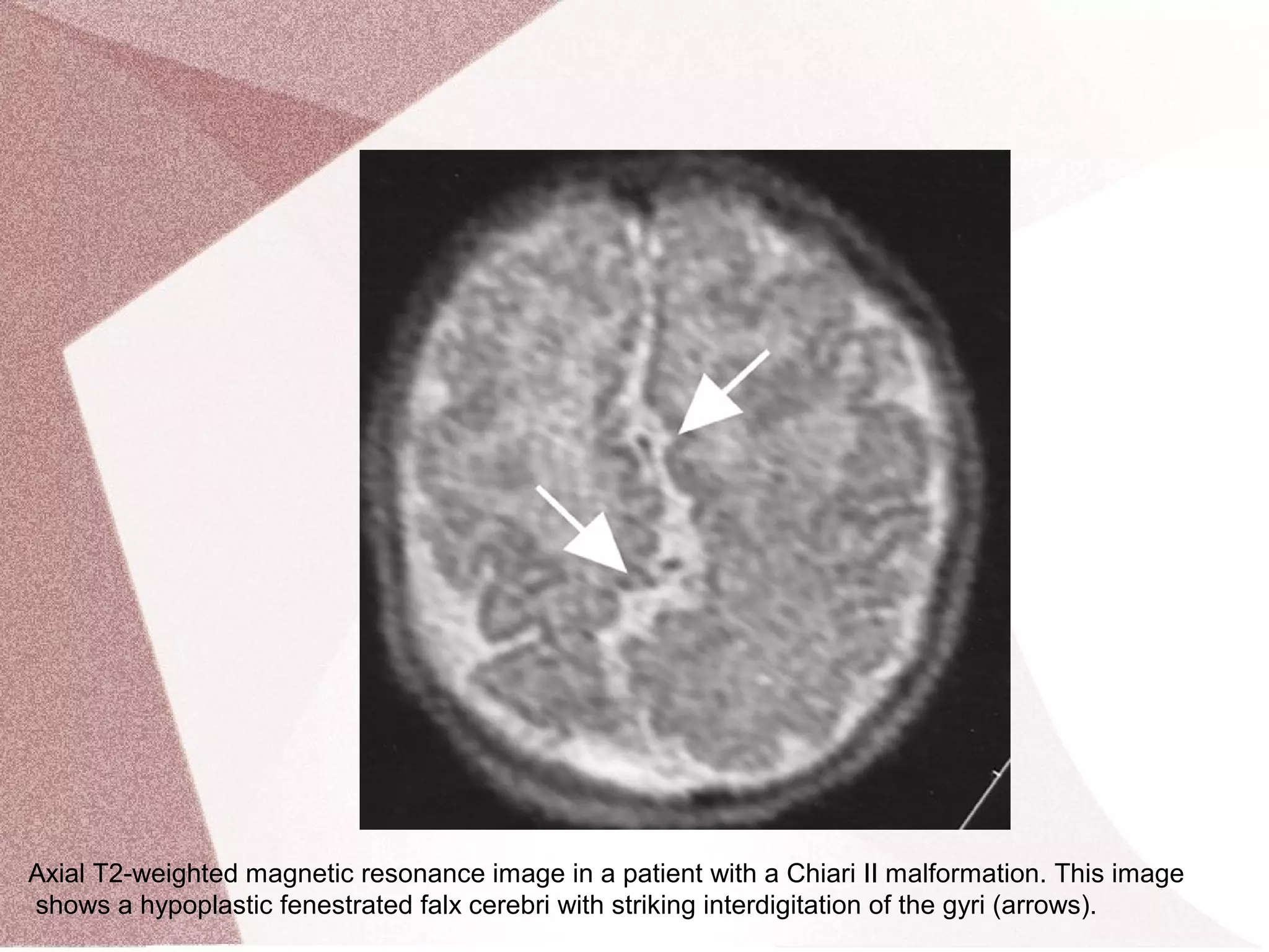 Congenital malformations of brain | PPT