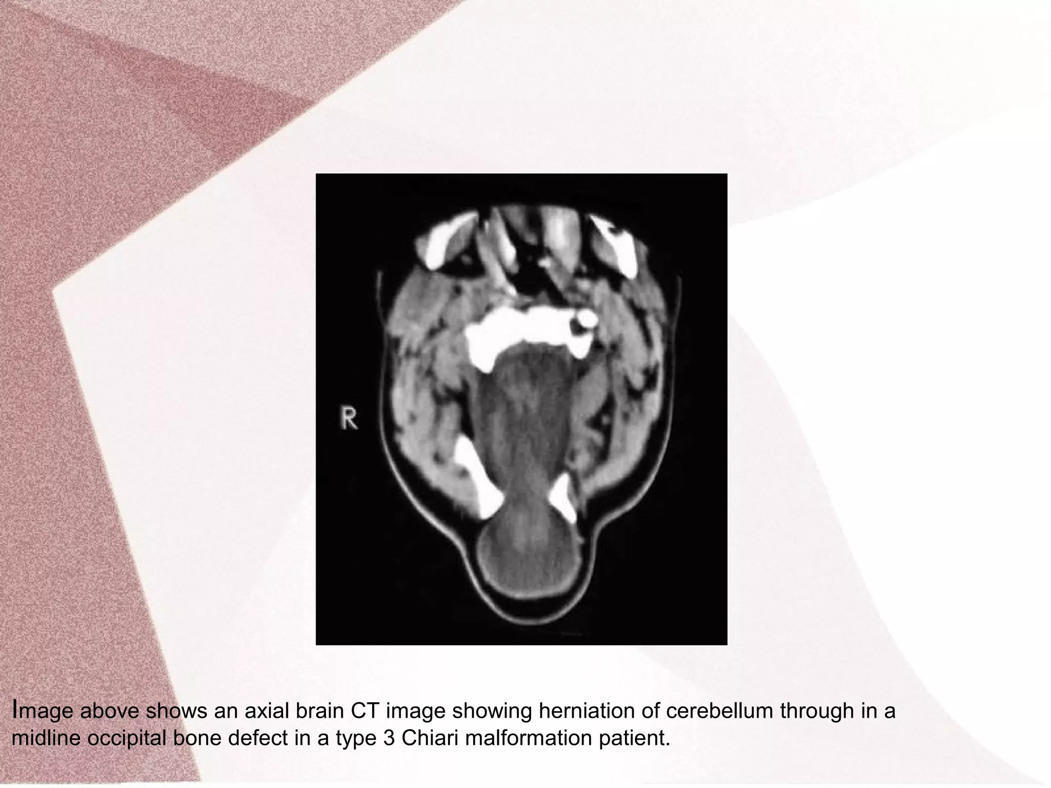 Congenital malformations of brain | PPT