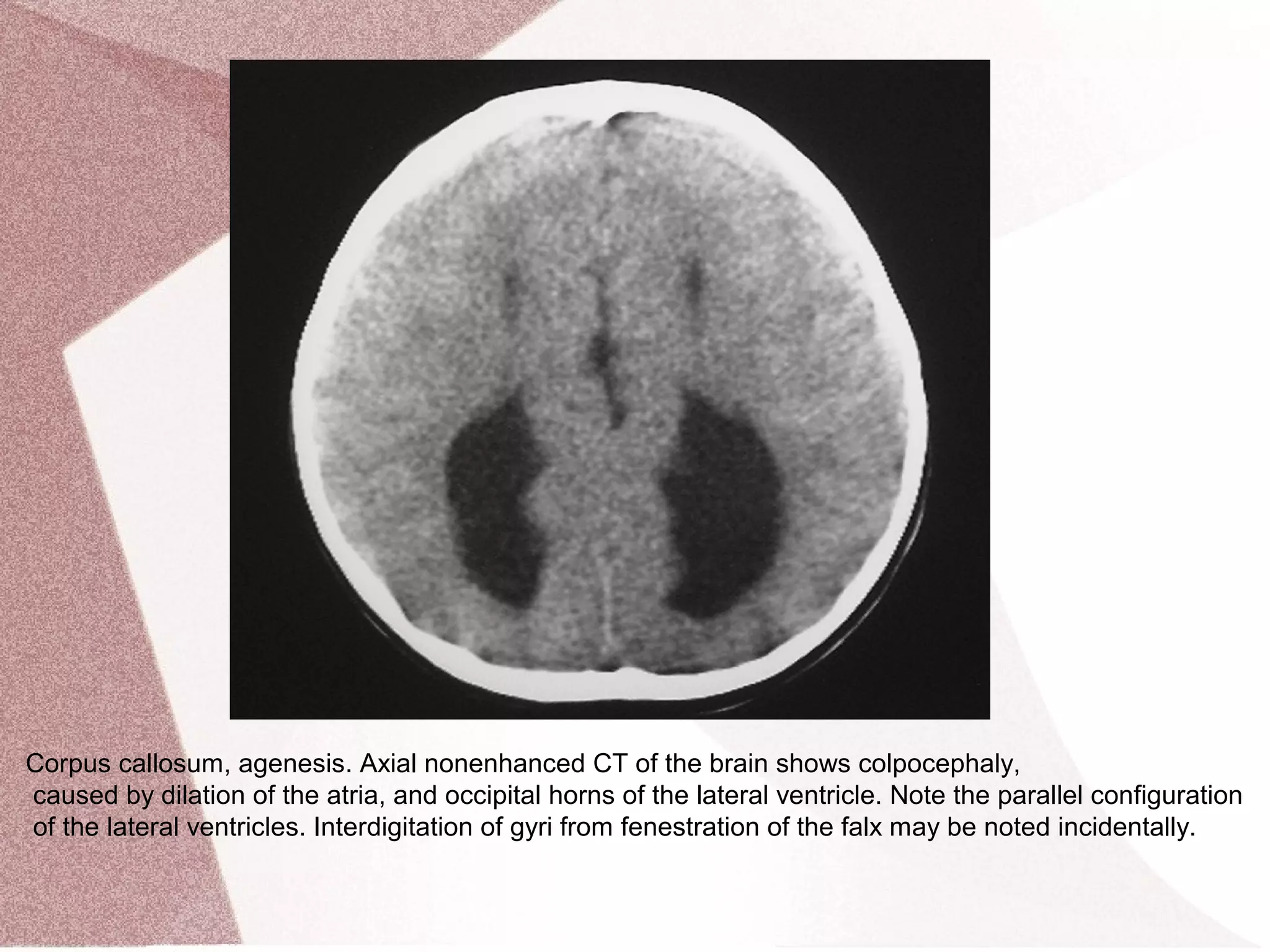 Congenital malformations of brain | PPT