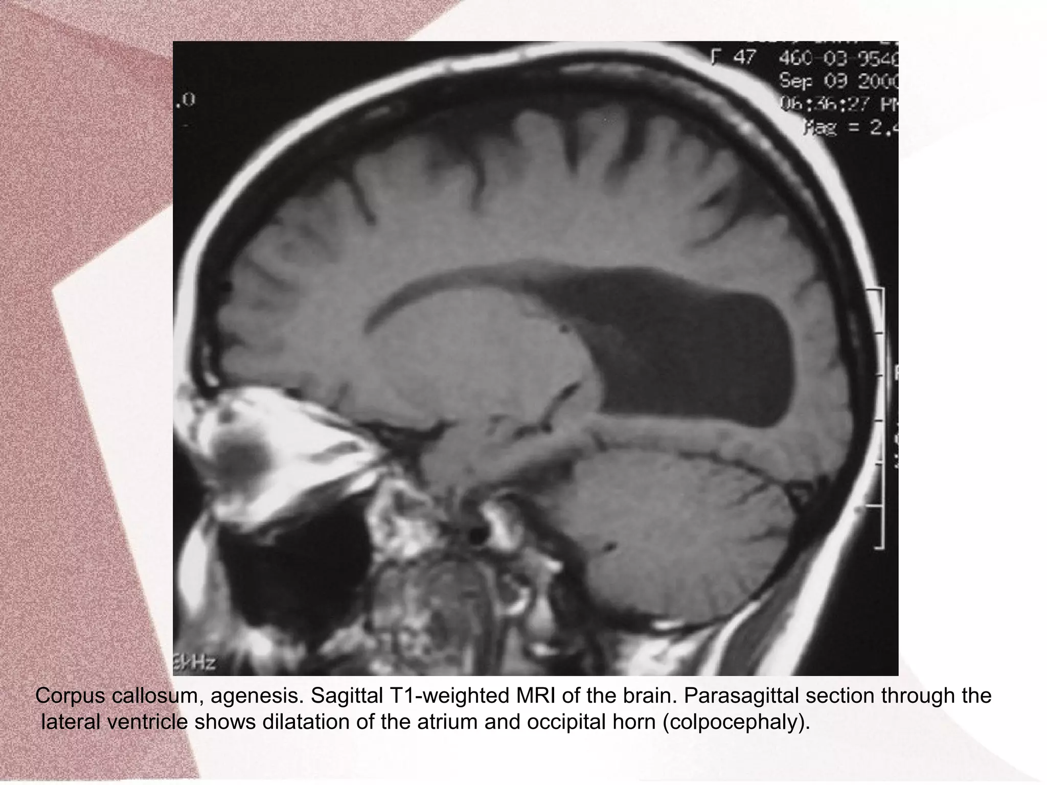 Congenital malformations of brain | PPT