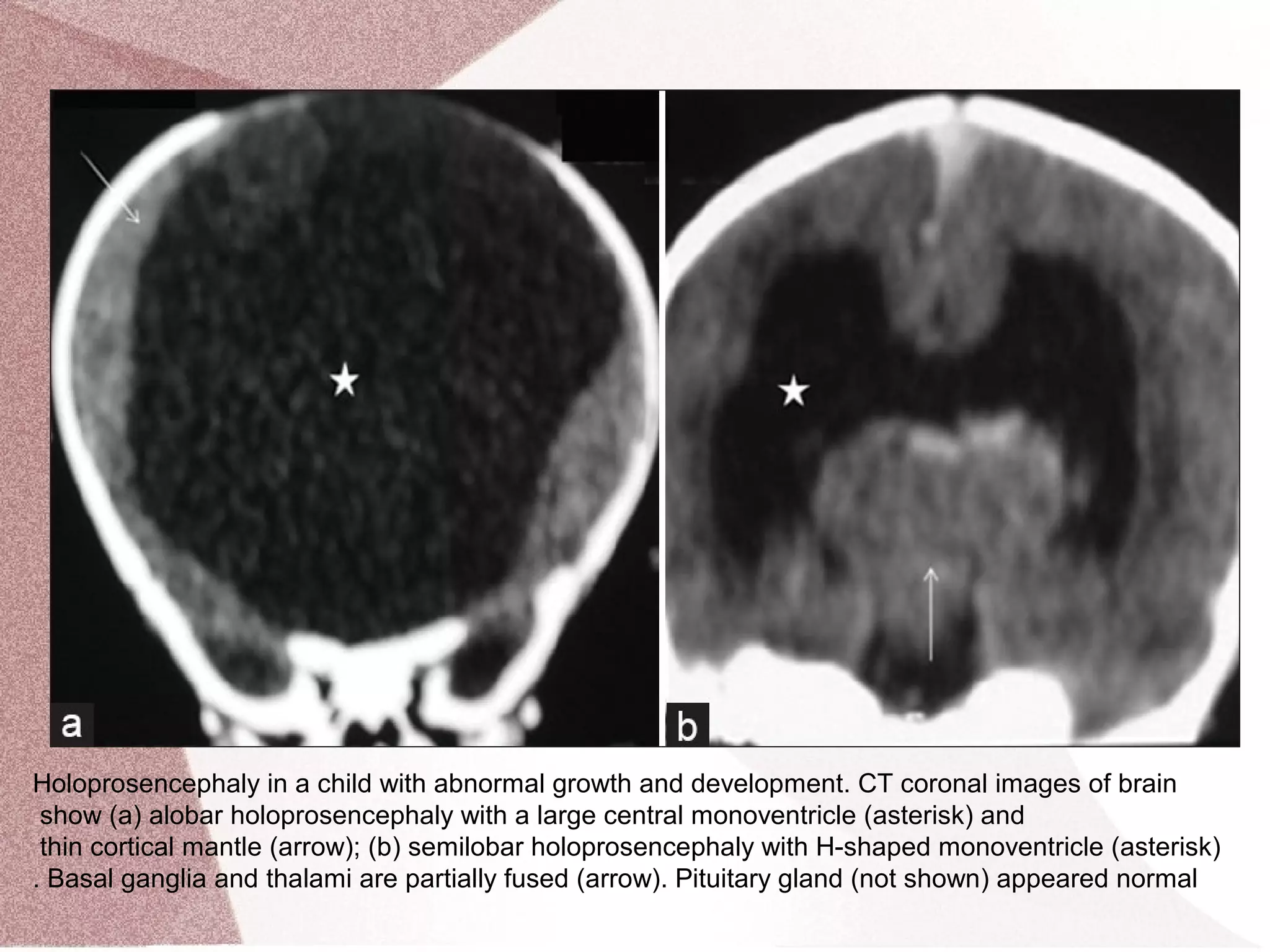 Congenital malformations of brain | PPT