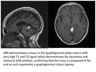 Congenital malformations of brain 2 | PPTX | Brain and Nervous System ...