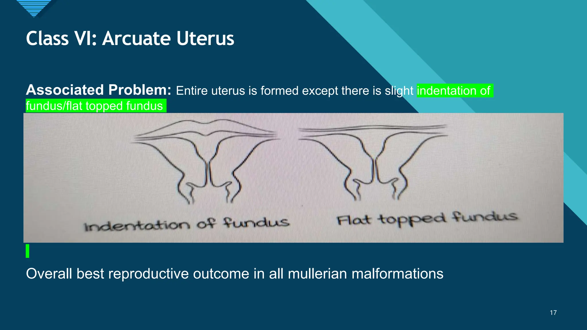 Congenital Malformations Of Female Genital - Priyanshu.pptx