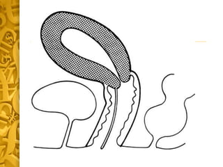 Congenital malformations of female genital tract | PPTX