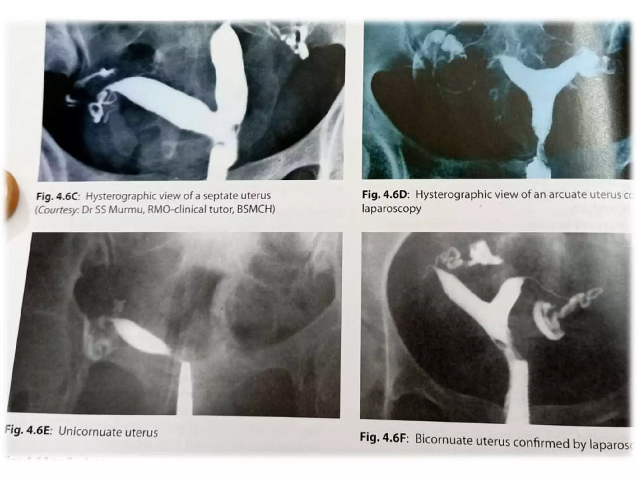 Congenital malformations of female genital tract ppt | PPTX