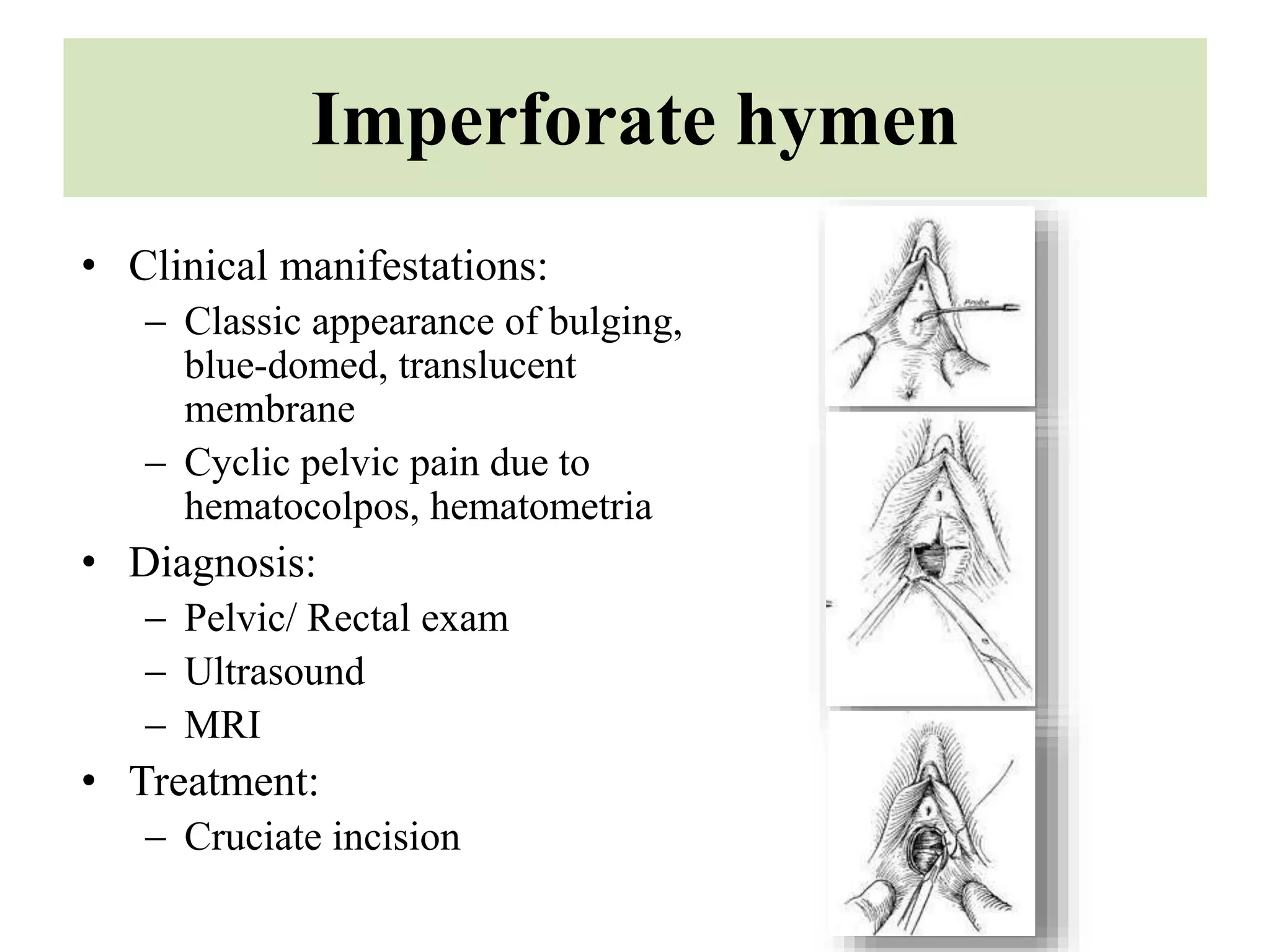 Congenital malformations of genital organs | PPTX