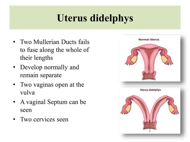 Congenital malformations of genital organs | PPTX
