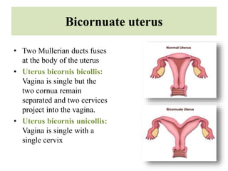 Congenital malformations of genital organs | PPTX
