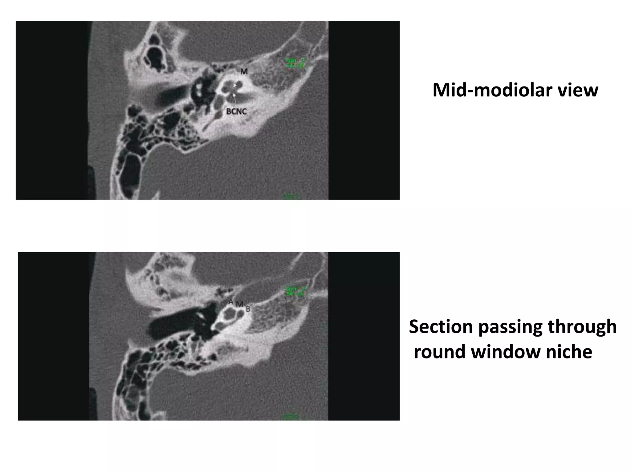 Congenital Malformations of Inner Ear.pptx