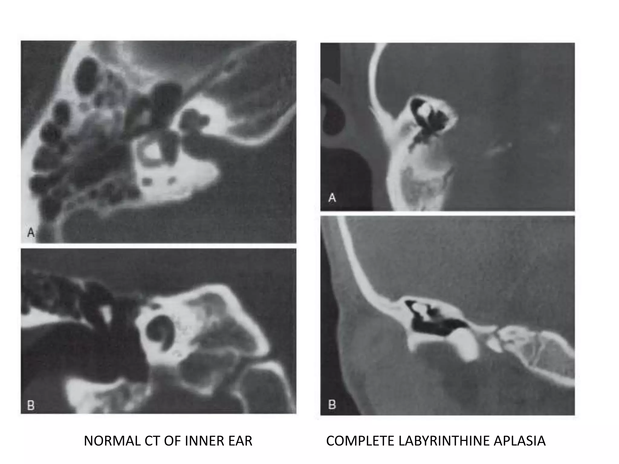Congenital Malformations of Inner Ear.pptx