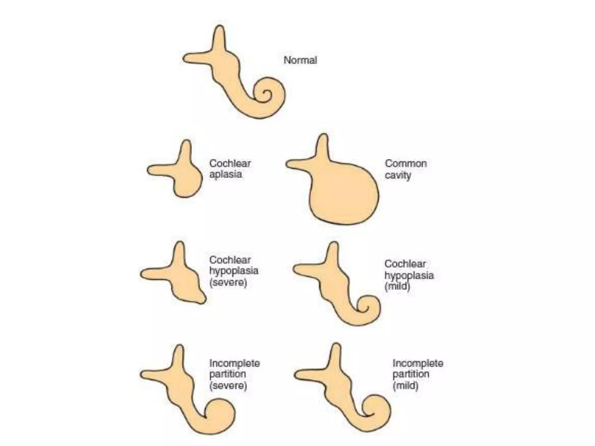 Congenital Malformations of Inner Ear.pptx